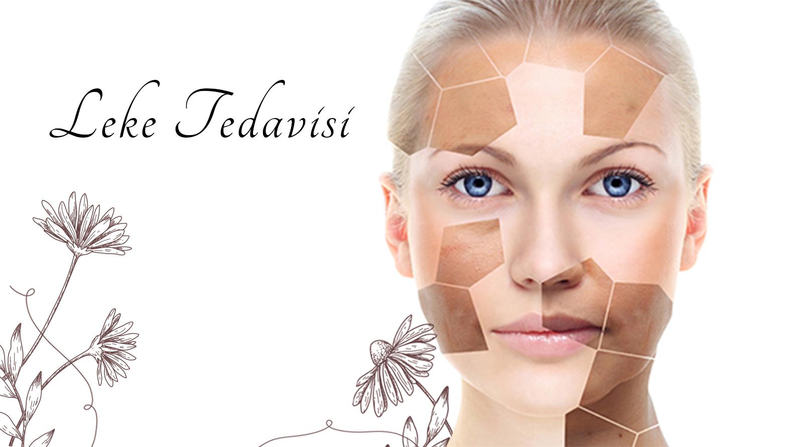 Leke Tedavisi: Nedir? Nasıl Yapılır? Yan Etkiler ve Sonuçlar | Op. Dr ...